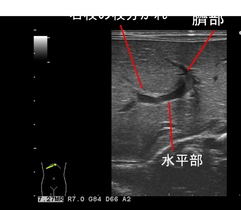 肝臓|腹部|基本編|こどもエコー塾
